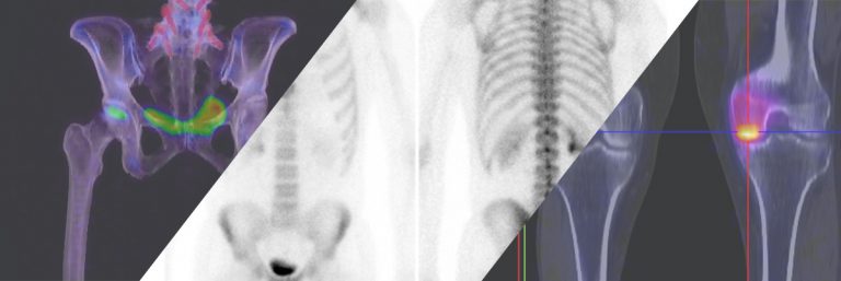 Scintigraphie osseuse – CIN Centre d'Imagerie Nucléaire St Etienne ...