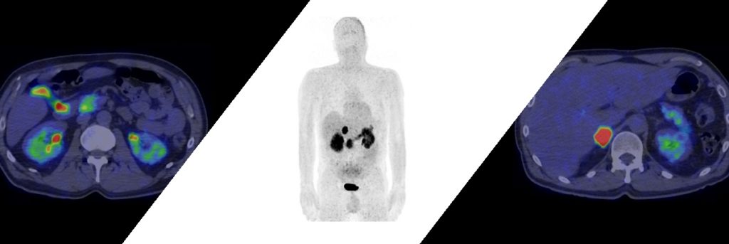 PET-scan à la F-Dopa – CIN Centre d'Imagerie Nucléaire St Etienne ...